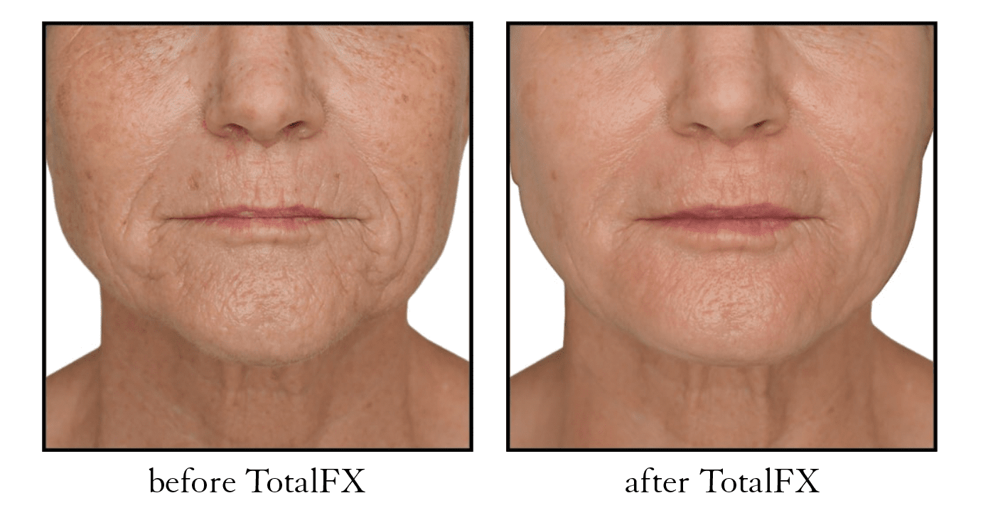 FX Laser Skin Treatment - CO2 laser | Cosmetic Skin & Laser Center