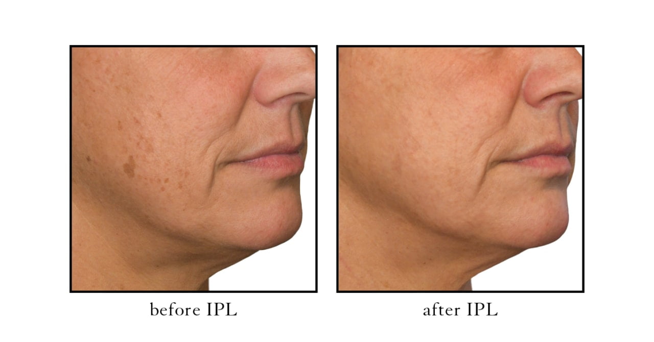 IPL- Traverse City - Petoskey - Naples | Cosmetic Skin & Laser Center