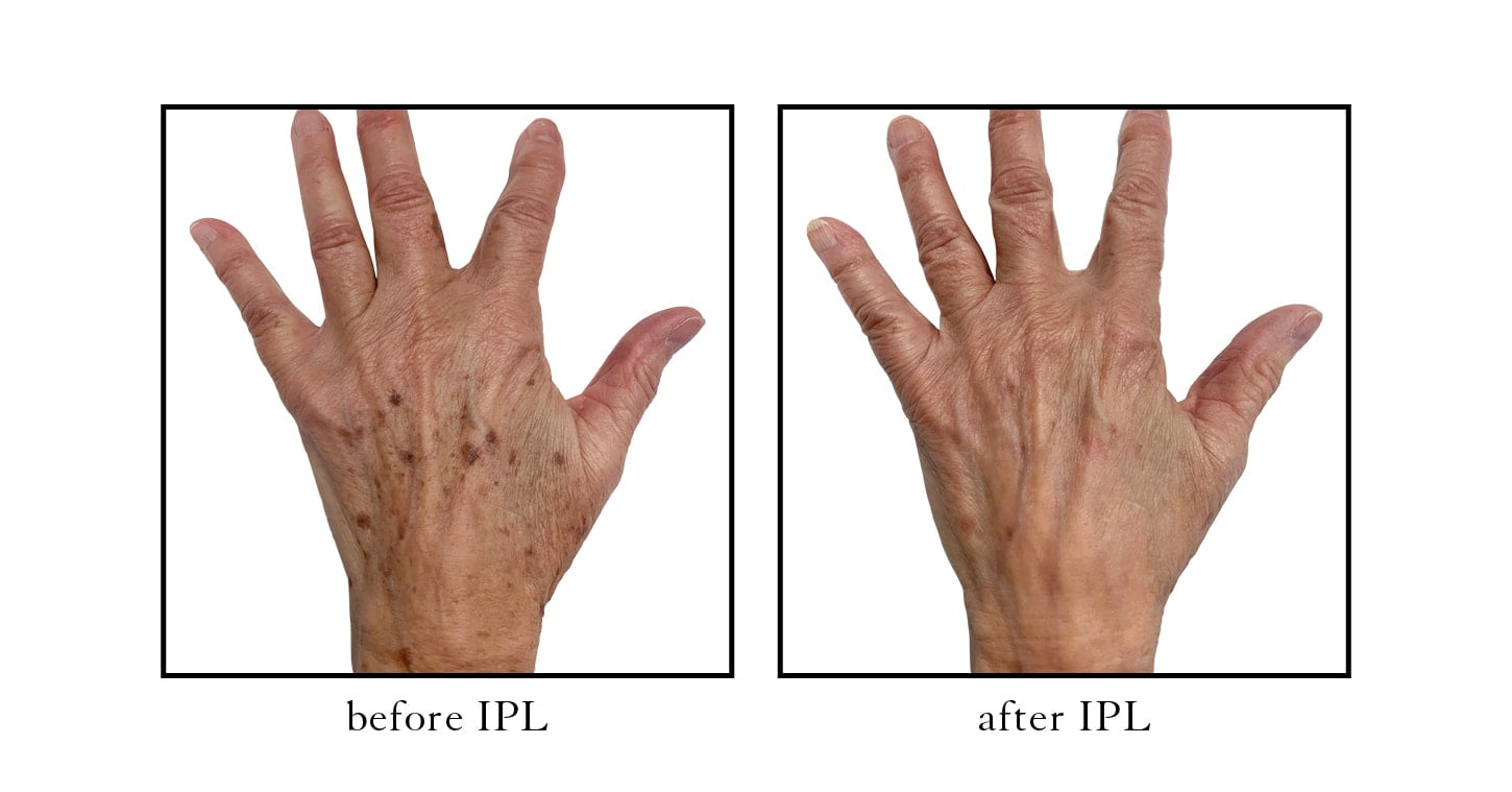 IPL- Traverse City - Petoskey - Naples | Cosmetic Skin & Laser Center