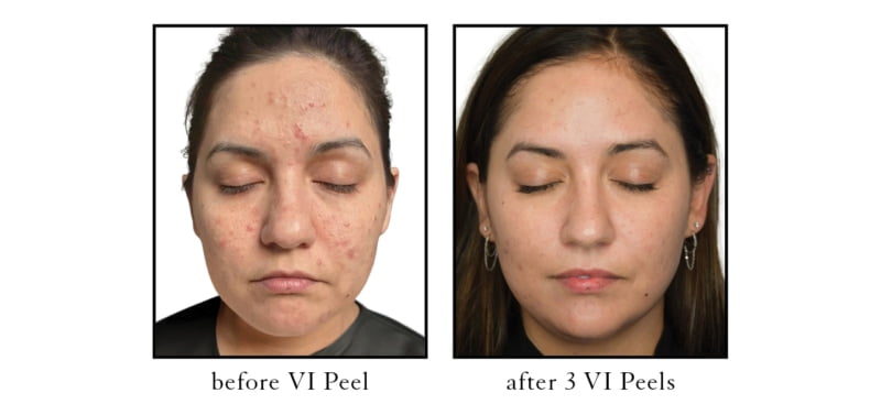 ViPeel - Chemical Peels - Skin Care | Cosmetic Skin & Laser Center