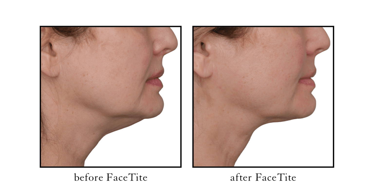 FaceTite - Gustav Lo, MD - Traverse City - Petoskey - Naples, FL