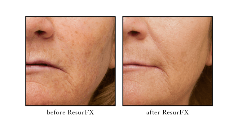 Gentle Laser Skin Treatments | Cosmetic Skin & Laser Center