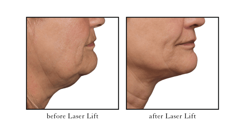 Laser Lift Facelift Alternative | Cosmetic Skin & Laser Center