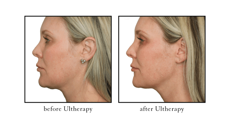 Ultherapy Skin Tightening | Cosmetic Skin & Laser Center