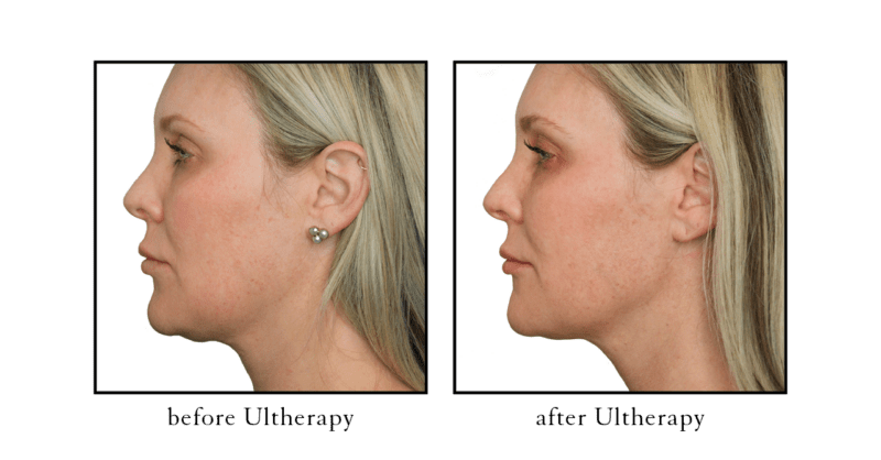 Ultherapy | Lift & Tighten Skin with Ultrasound | CSLC