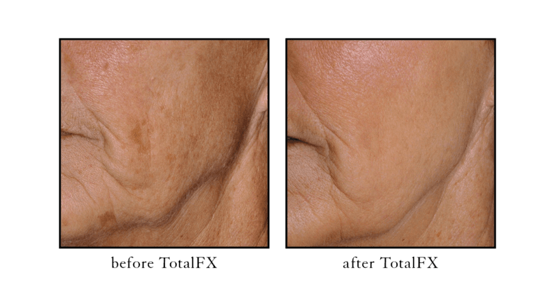 CO₂ Laser Resurfacing | Advanced Fractional FX Laser at CSLC