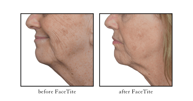 FaceTite - Gustav Lo, MD - Traverse City - Petoskey - Naples, FL