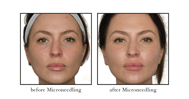 Microneedling PRP & PRF Naples Fl, Petoskey & Traverse City