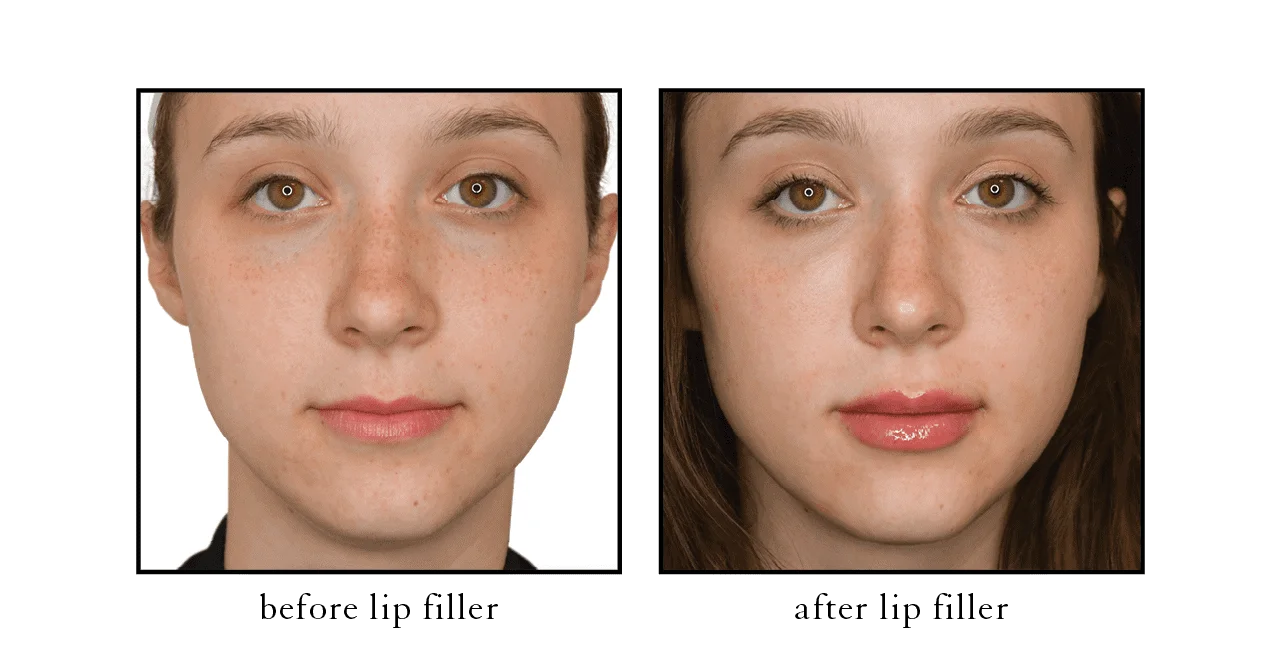 Filler Naples Restylane | Cosmetic Skin & Laser Center