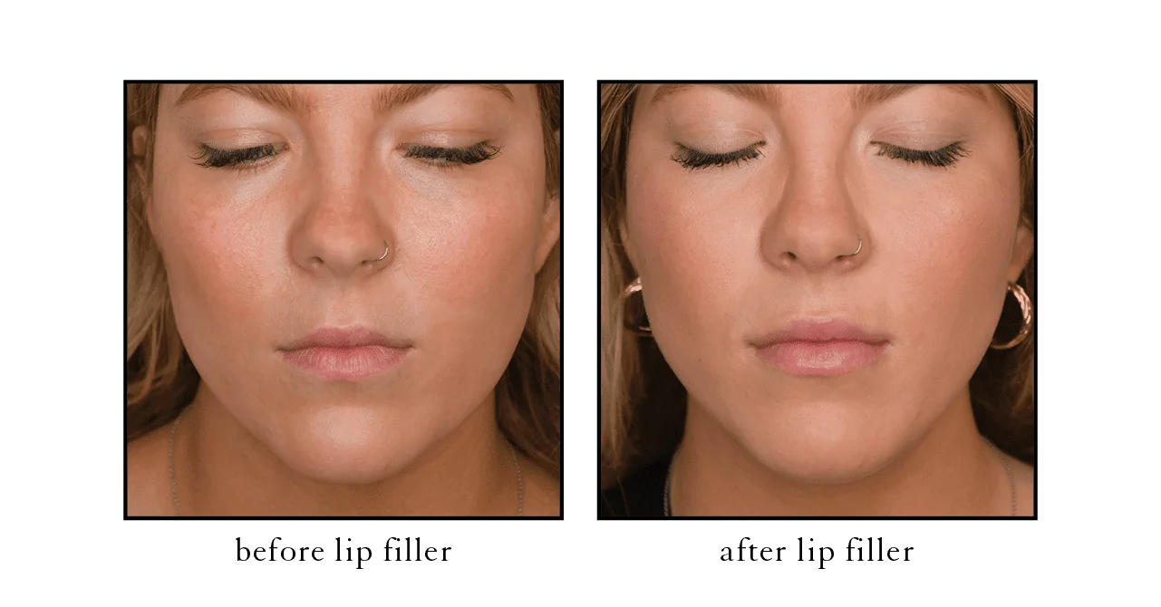 Filler Naples Restylane | Cosmetic Skin & Laser Center
