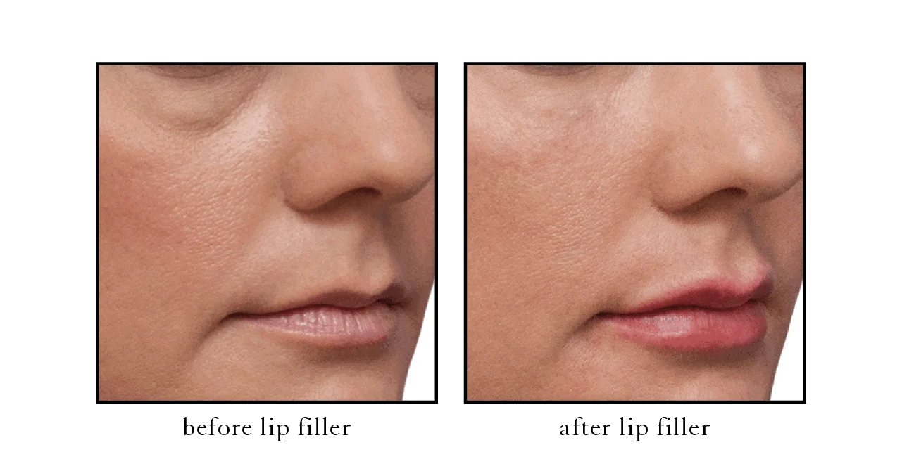 Filler Naples Restylane | Cosmetic Skin & Laser Center