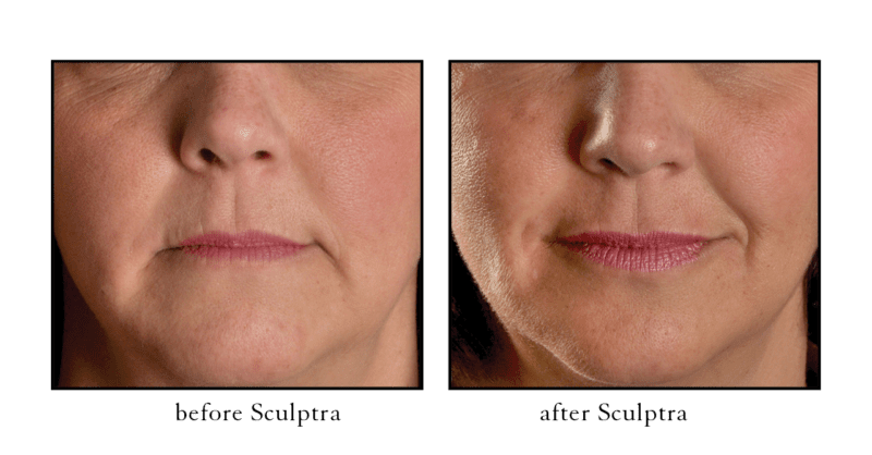 Sculptra Naples-Petoskey-Traverse | Cosmetic Skin & Laser Center