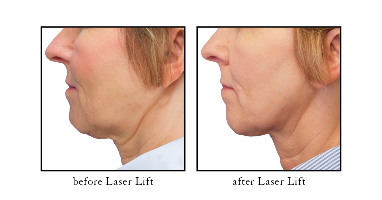 Botox Before & After Photos - Before & Afters Gallery - CSLC