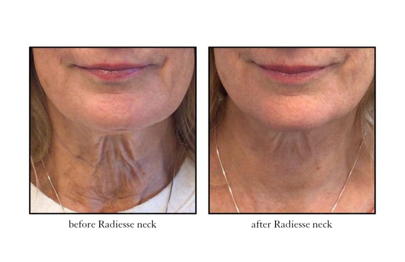 Radiesse for Collagen Building, Rejuvenation and Thin Skin - CSLC